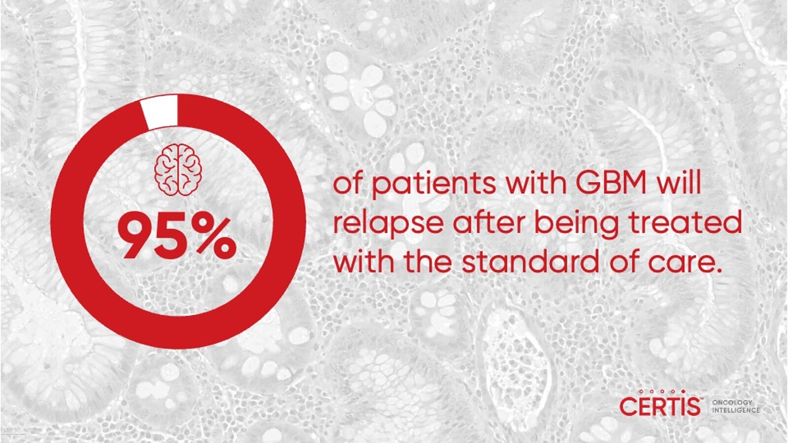 Overcoming Critical Issues in Glioblastoma Multiforme (GBM) Therapeutic ...