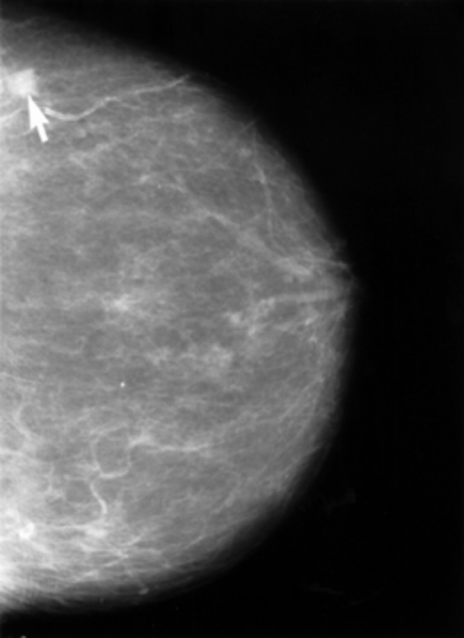 Rare Diseases and Breast Cancer | Scientist.com